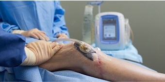 3M™ Veraflo™ Therapy | 3M India